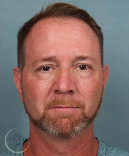 Patient #8984 Blepharoplasty Before and After Photos Florham Park, NJ ...