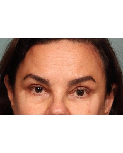 Patient #9064 Blepharoplasty Before and After Photos Florham Park, NJ ...