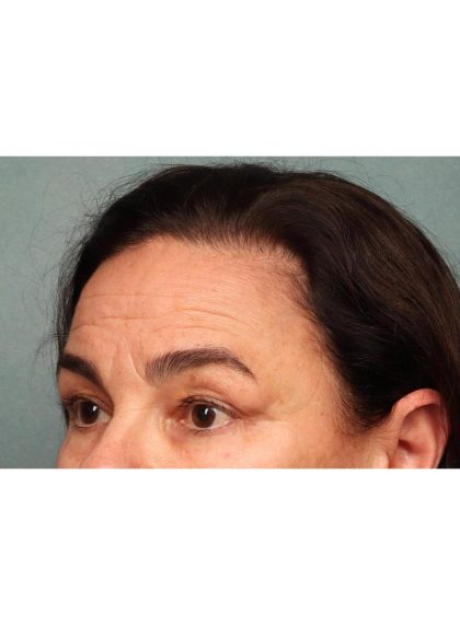 Patient #9064 Blepharoplasty Before and After Photos Florham Park, NJ ...